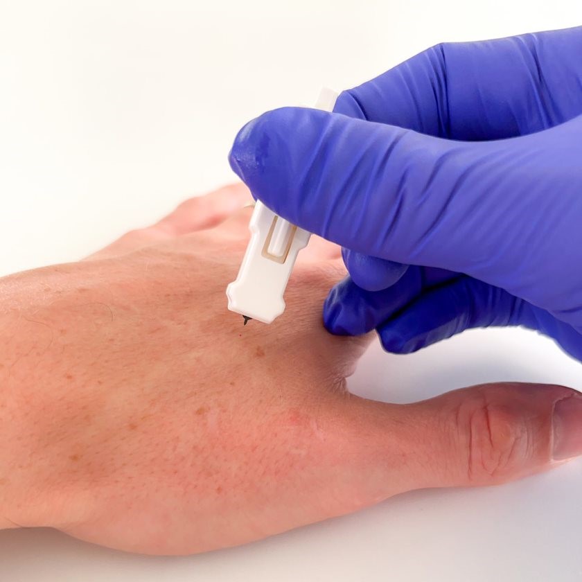 A New Way to Biopsy and Analyze Skin Conditions