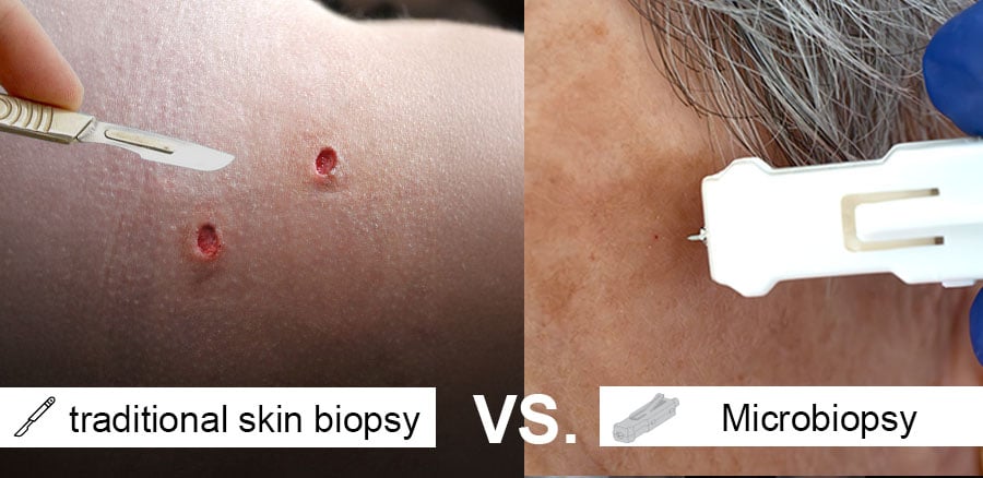 Microsampling Blog | Neoteryx | Skin Microsampling, Microbiopsy