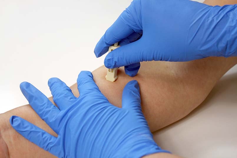 New Minimally Invasive Skin Microbiopsy For Inflammatory Skin Diseases