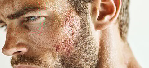 Microsampling Blog | Neoteryx | Skin Microsampling, Microbiopsy